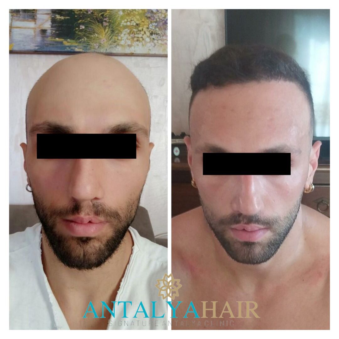 Hair Transplant - Estevitalya Hair