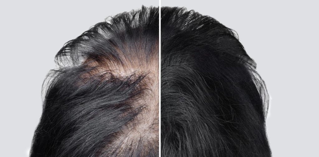 Understanding Alopecia - Expert Insights | Estevitalya Hair