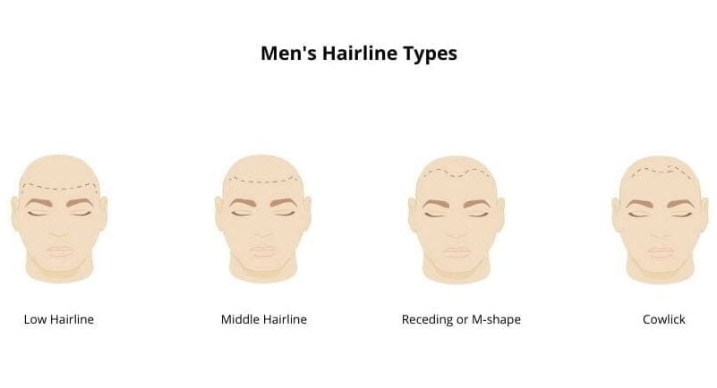 Understanding Hair Transplant: Guide to Different Hairline Types
