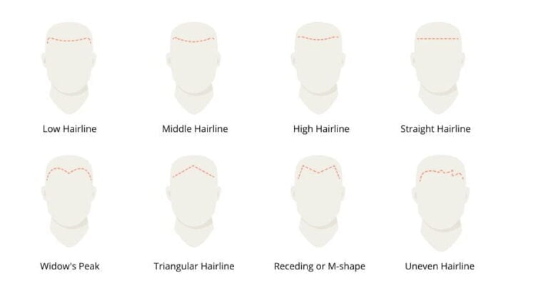 Understanding Hair Transplant: Guide to Different Hairline Types