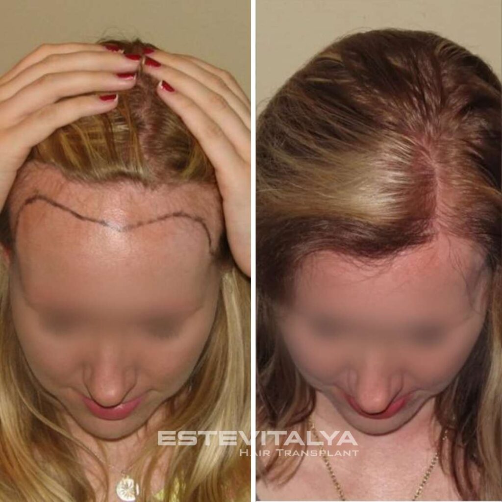 FUE Hair Transplant - Estevitalya Hair