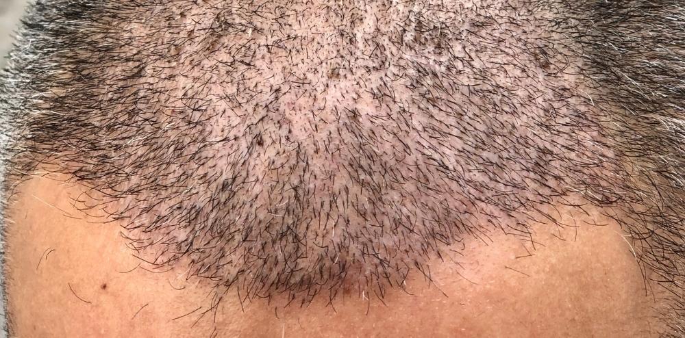 Hair Transplant Healing Process: From Day One to Full Recovery