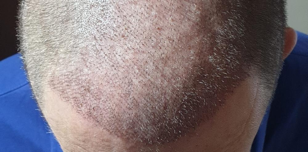Hair Transplant Healing Process: From Day One to Full Recovery