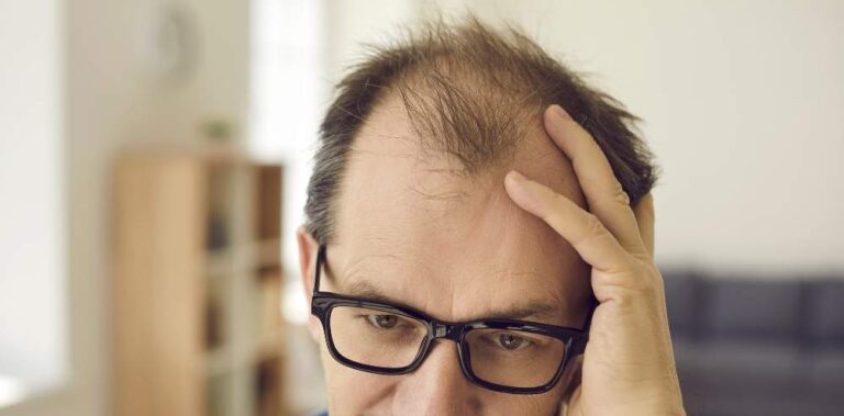 Male Pattern Baldness Onset: Early Signs & Causes - Estevitalya Hair