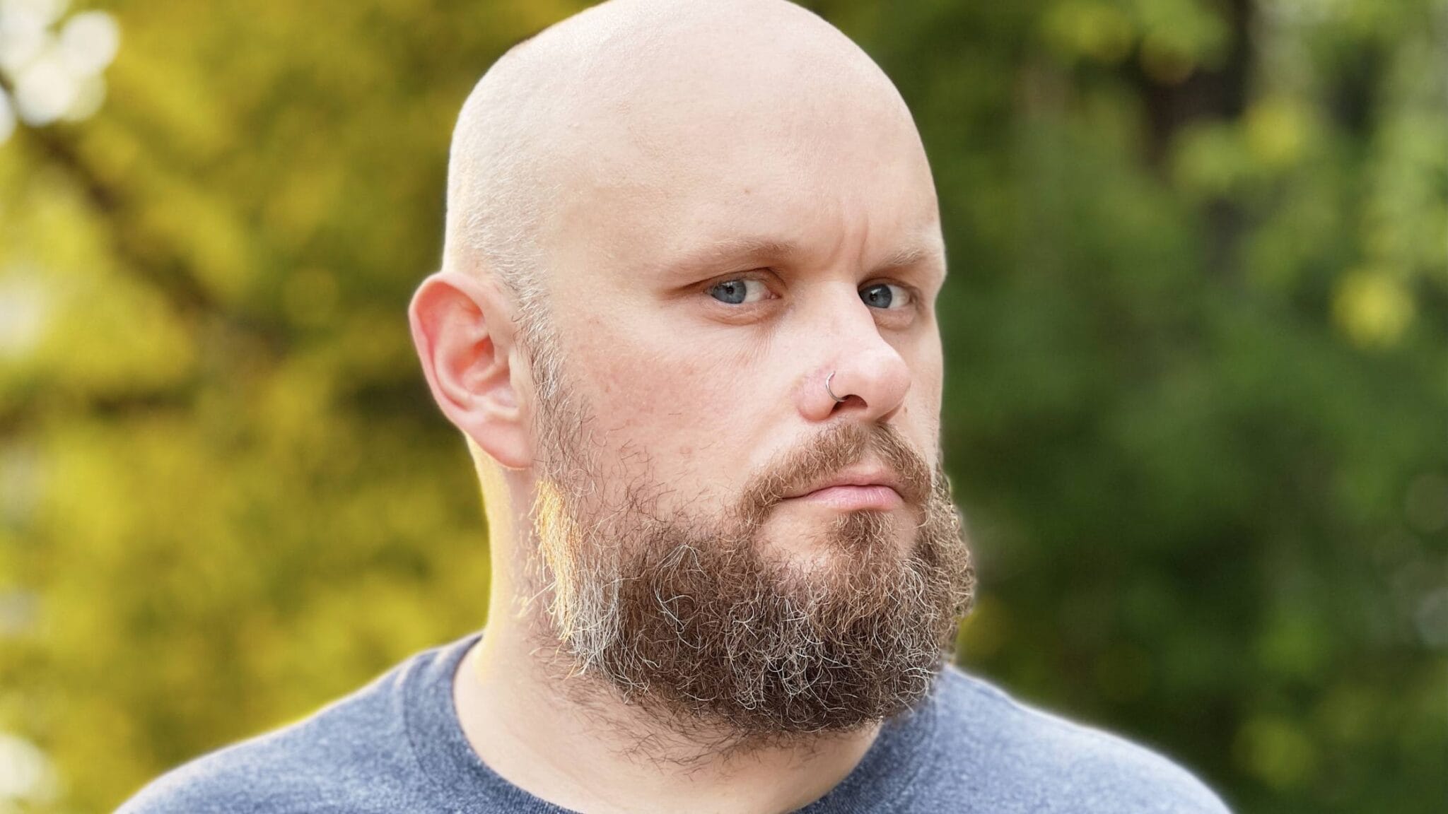 Revolutionising Hair Transplants: Beard to Scalp Insights
